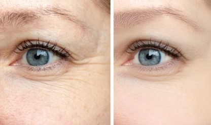 Achieving Smooth Under-Eyes: A Comprehensive Look at Under Eye Botox ...